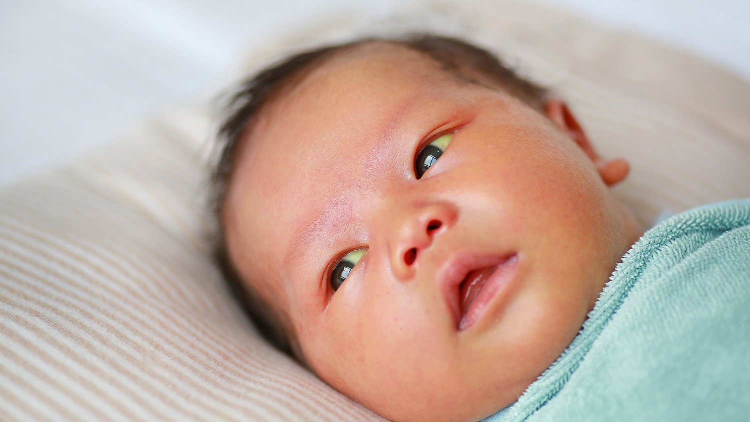Jaundiced Baby Jaundice And Kernicterus Information For Families | CDC