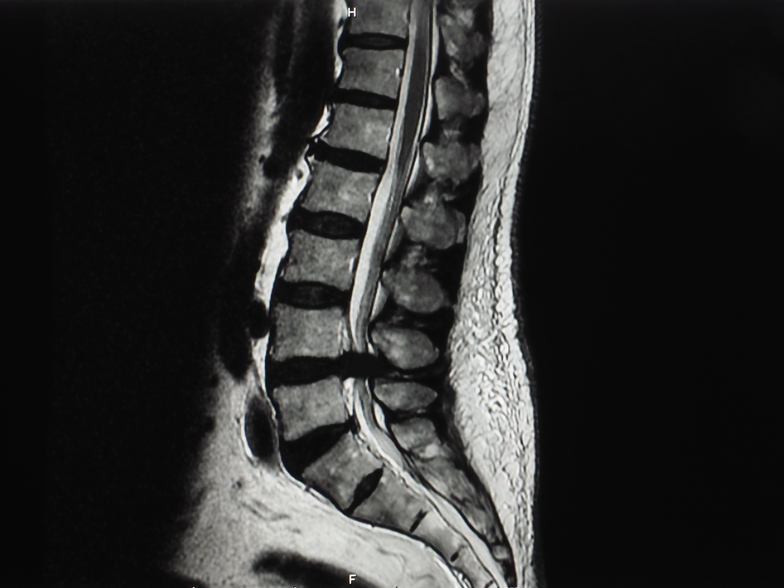 Sciatica Vs Cauda Equina Syndrome Medical Emergency
