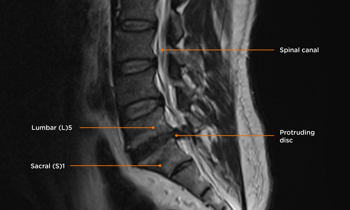 Cauda Equina Mri Cauda Equina Mri